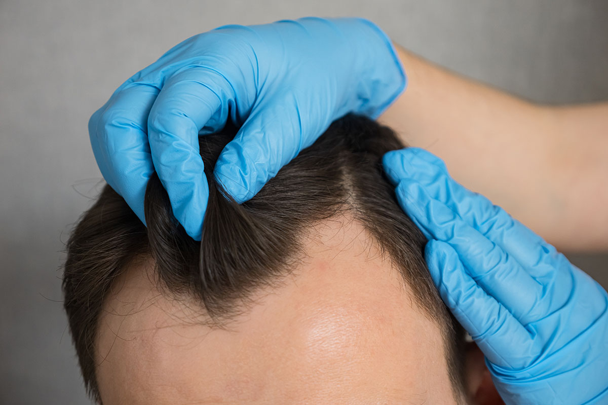Hair Transplant Columbus, Ohio | The Toronto Hair Transplant Clinic